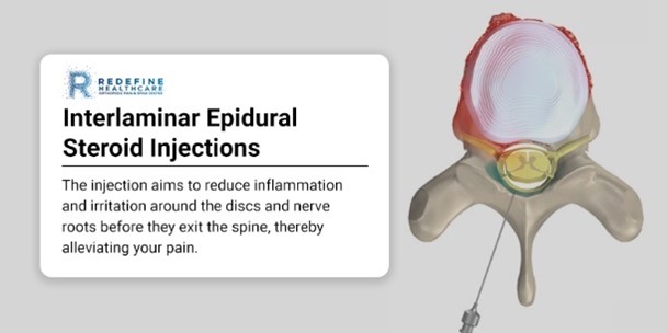 Cervical Interlaminar Epidural Injection | Solutions In Pain