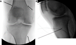 Knee Genicular Nerve Block / Radiofrequency Ablation | Solutions In Pain