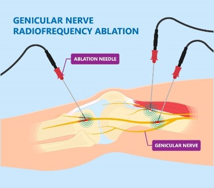 Knee Genicular Nerve Block / Radiofrequency Ablation | Solutions In Pain