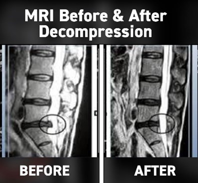 Minimally Invasive Lumbar Decompression | Solutions In Pain