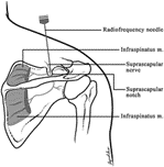 Shoulder Joints Nerve Block /Radiofrequency ablation | Solutions In Pain