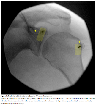 Shoulder Joints Nerve Block /Radiofrequency ablation | Solutions In Pain
