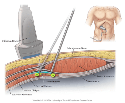 Transversus Abdominal Plane Block for Postoperative Pain Relief
